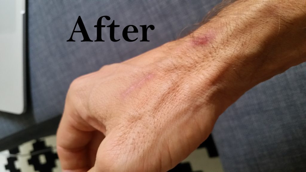 Scar therapy with our RJ Physio Laser after 6 sessions, here are the ...